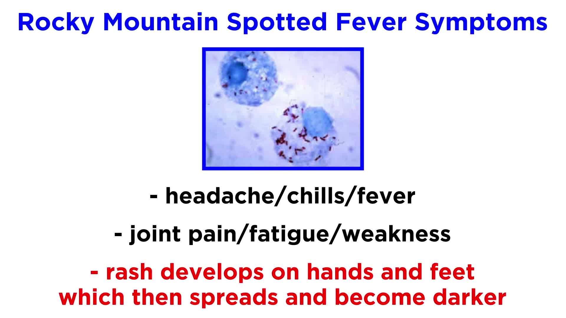 Rocky Mountain Spotted Fever Rickettsia rickettsii | Science